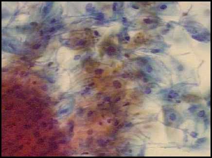 Gyn Cytopathology