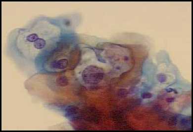 Gyn Cytopathology